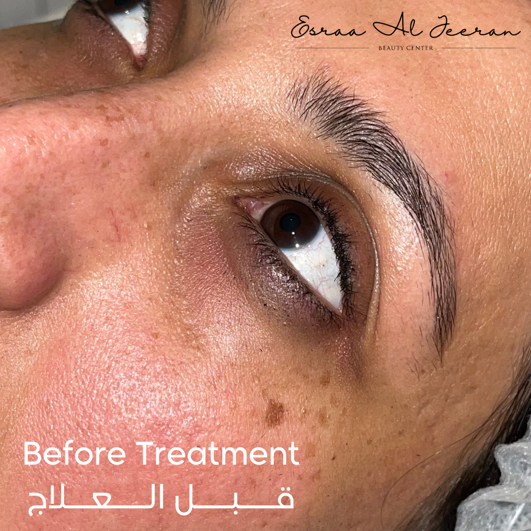 علاج تحت العين (ميزو) – EMJ Beauty Center